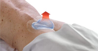 Medline introduces first-of-its-kind transparent wound dressing aiding ...